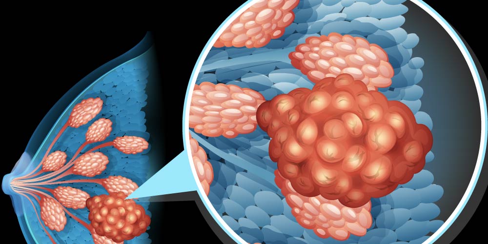 Breast Cysts - Dr de Viana
